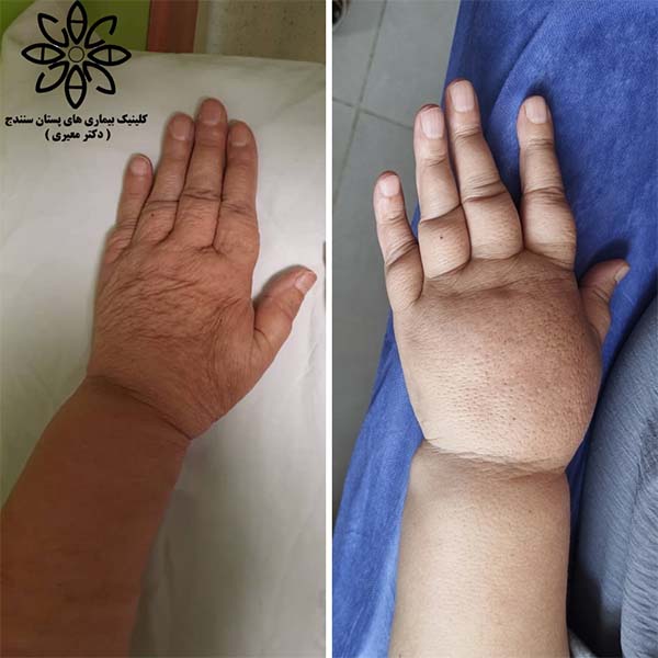 آموزش ماساژ لنف ادم شانه و دست - دکتر حسن معیری